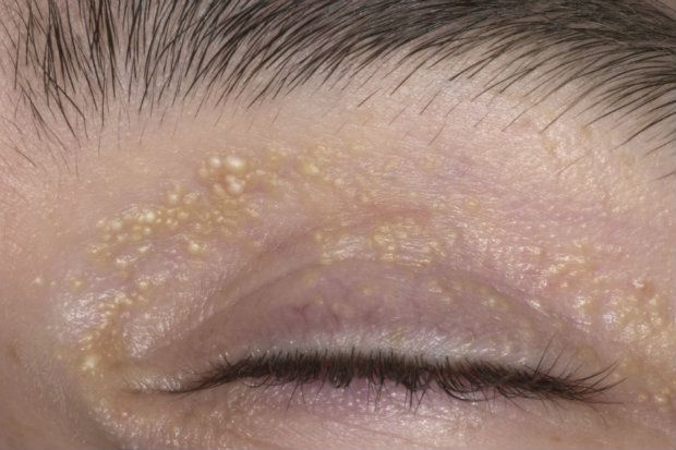 What Are These White Dots Around The Eye Chemist Druggist what-are-these-white-dots-around-the-eye-chemist-druggist